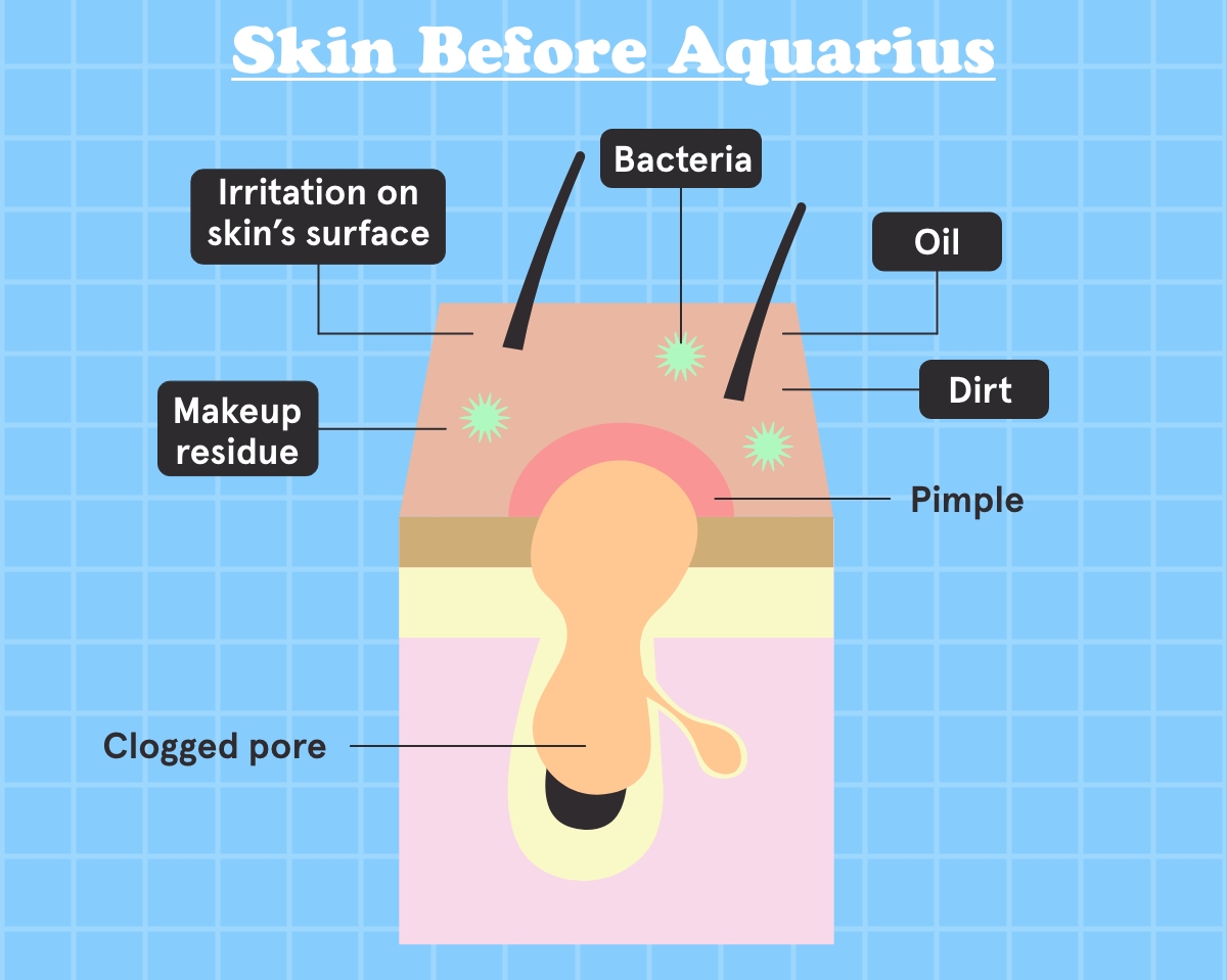 Clogged Pores Diagram